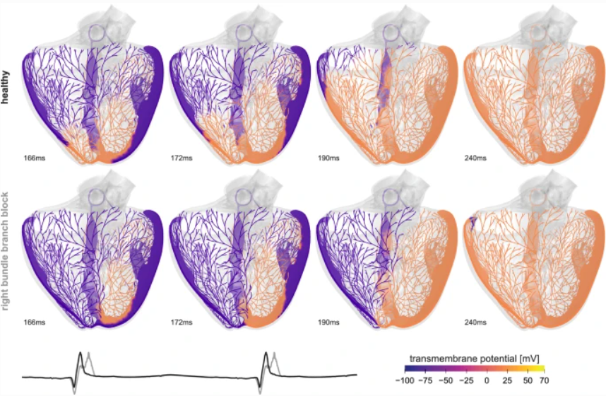 Heart Modeling Progresses Toward a Future of Personalized Medicine ...
